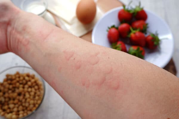 Food Allergy – Causes, Symptoms & Treatments