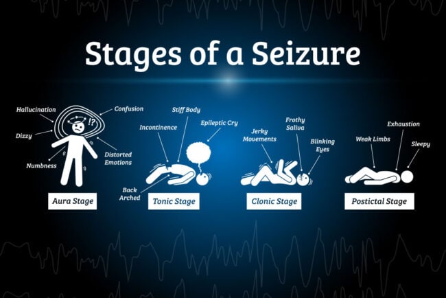 Epilepsy or Seizure First Aid: What to Do | Human Focus